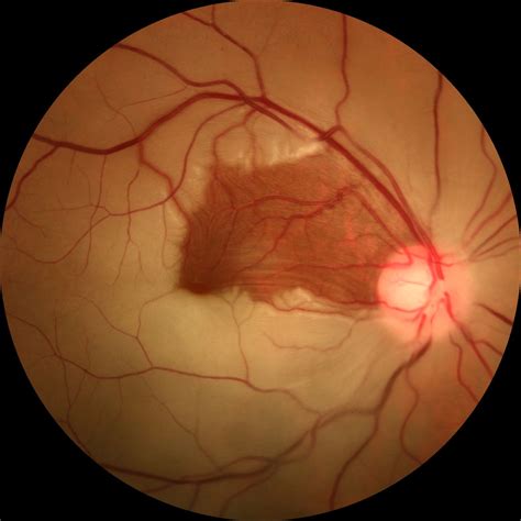 Central Retinal Artery Anatomy