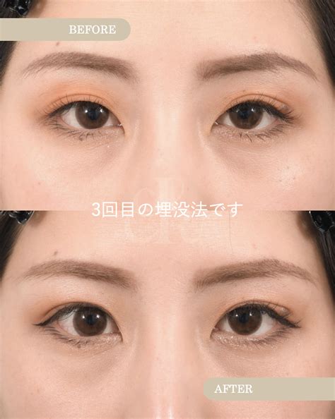 【症例】二重まぶた・埋没法（2点、たるみ改善） 〈case 043〉 コラム 顔のクリニック金沢｜金沢の美容外科・形成外科