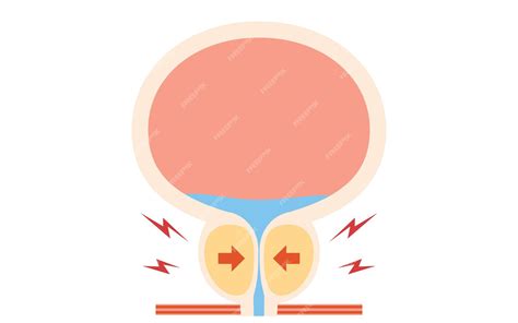 Premium Vector Medical Illustration Of Benign Prostatic Hyperplasia