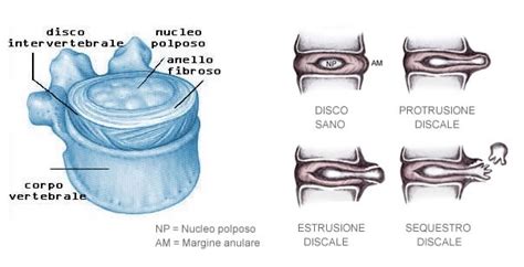 Ernia Cervicale