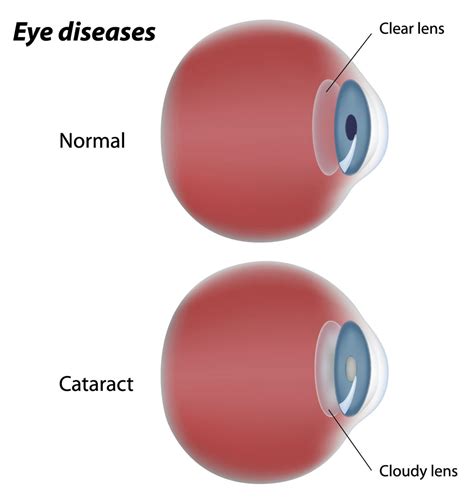 Lens Replacement Surgery For Glaucoma At Kate Terry Blog