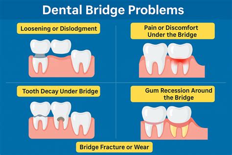 Dental Bridge Problems Causes Symptoms And Solutions Gateway Of Health