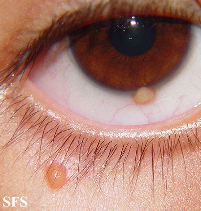 Juvenile Xanthogranuloma Wikidoc