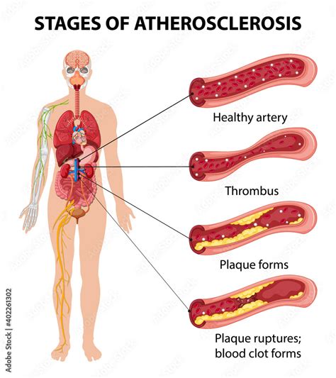 Stages Of Atherosclerosis Information Infographic Stock Vector Adobe Stock