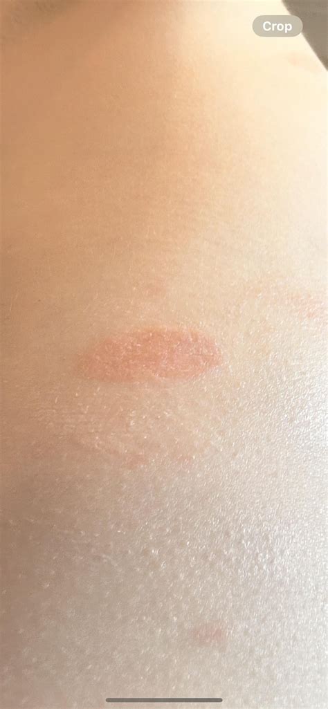 Do You Think This Is Ringworm Or Pityriasis Rosea Rdermatologyquestions