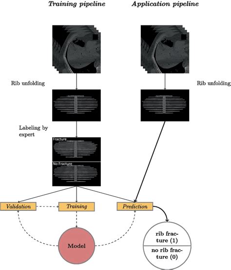 Workflow Of Rib Fracture Detections Volumetric Pmct Data Of Rib