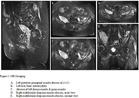Pyomyositis Attributed To Acupuncture A Case Report And Review Of