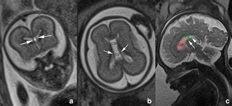 Imaging Of The Septum Pellucidum Normal Variants And Pathology Pmc