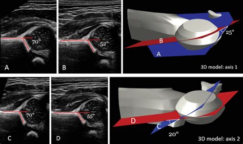 How To Draw Alpha Angle Hip