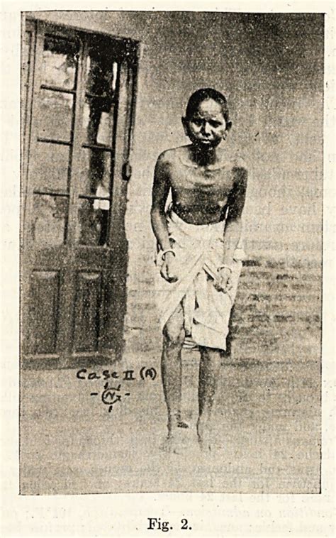 Figure 1 From Encephalitis Lethargica In Assam Semantic Scholar