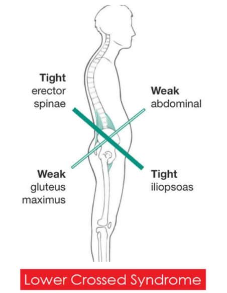 Lower Crossed Syndrome Symptoms