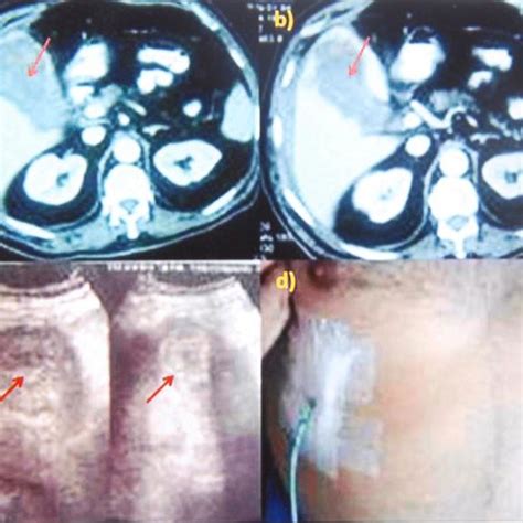A B Enlarged Gallbladder With Hematomawithout Stone C Gallbladder