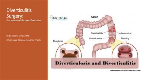 Diverticulitis Surgery Procedure And Recovery Southlake Pdf