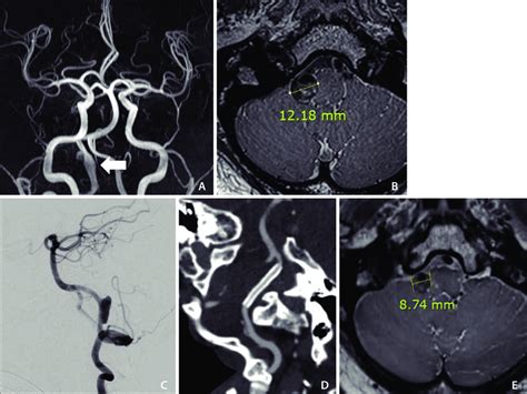 A Case Of Right Vertebral Artery Dissecting Aneurysm Vada With Tapia