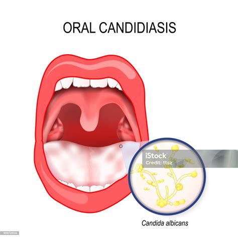 Orale Candidiasis Gist Infectie Ofl Candida Albicans De Mond Stockvectorkunst En Meer Beelden