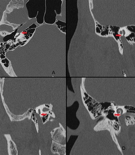 Carotid Foramen Ct