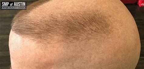 Scalp Micropigmentation Can Cover Hair Transplant Scars Smp Of Austin