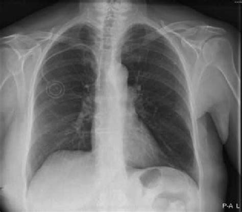 Fully Rotated Port X Ray Download Scientific Diagram