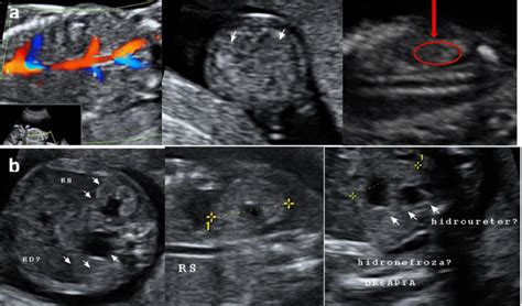 A Case Of Unilateral Mcdk Ultrasound Examination Negative In The