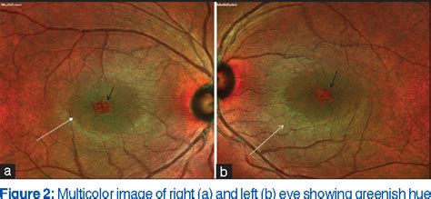Figure 1 From Multimodal Imaging In Dominant Cystoid Macular Dystrophy