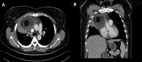 A Visual Compendium Of Teratomas And Their Diverse Anatomical Locations