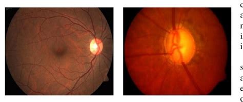 Figure From Retinal Glaucoma Detection From Digital Fundus Images Using Deep Learning Approach