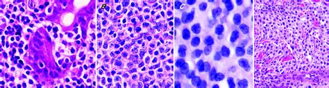 Mucosa Associated Lymphoid Tissue Malt Lymphoma A Practical Guide