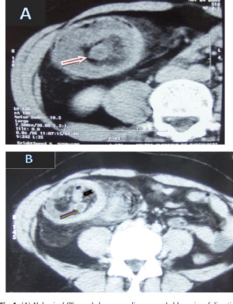 Figure 1 From International Journal Of Surgery Case Reports Appendiceal Intussusception To The