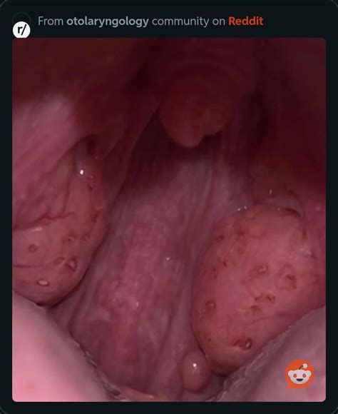 Lump Underneath Tonsil Raskdoctorsmeeee