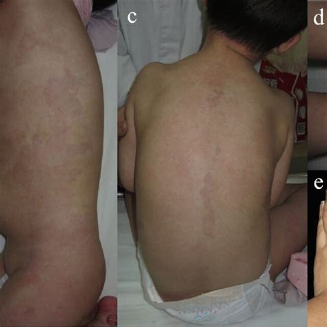 Clinical Manifestations Of The Patient With Proteus Syndrome A B