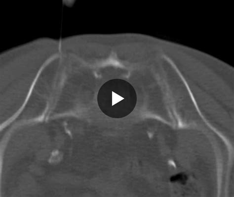 Sacroiliac Joint Injection Procedure Guided By Computed Tomography