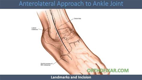Anterolateral Approach To Ankle Joint • Full And Easy • Orthofixar 2025