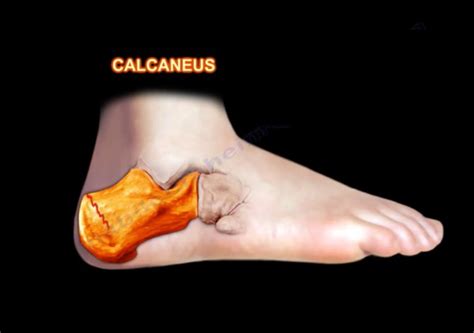 Stress Fractures Of The Calcaneus —