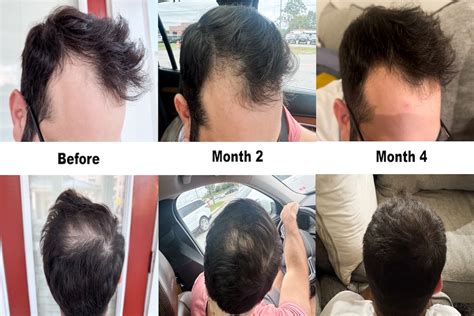 The Best Hair Loss Treatments For Men 2026 Fortune
