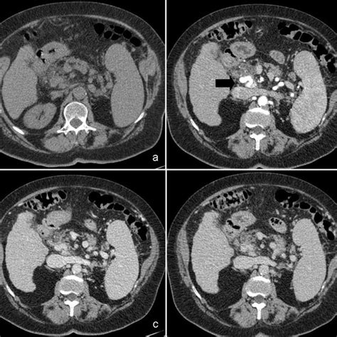Quadriphasic Mdct Axial Images Showing A Hypervascular Lesion In The