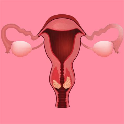 Symptoms Of Cervical Cancer In Women