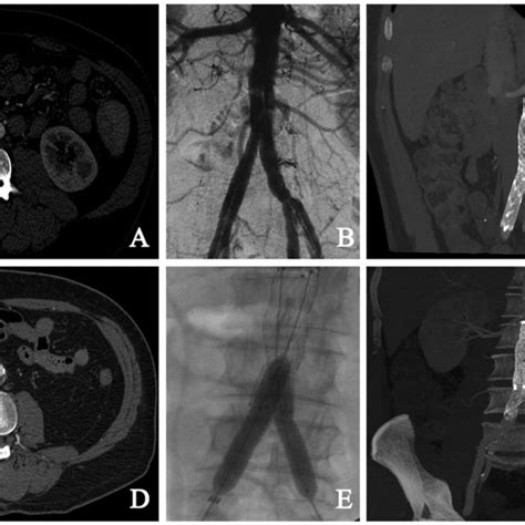 Svensson Classification 6 I Classic Aortic Dissection With Intimal