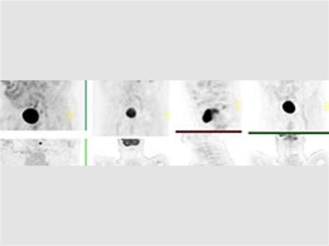 Biograph Mct Flow Siemens Healthineers Türkiye