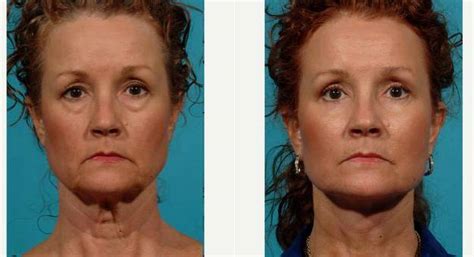 59 Year Old Woman Treated With Facelift Before And After By Doctor P