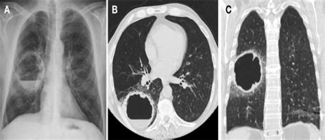 A Chest Xray Examination B And C Ct Scan Showing The Cavities In