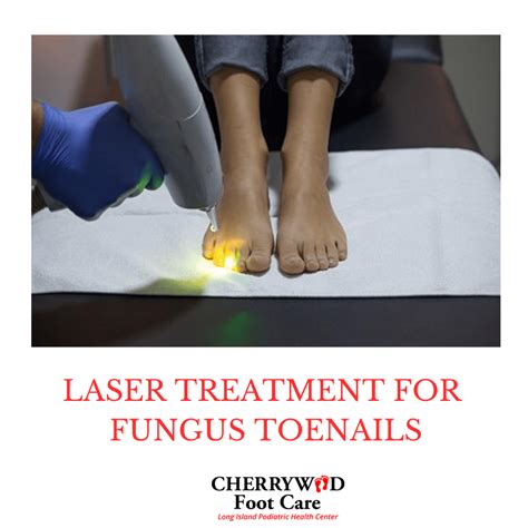 Laser Treatment For Toenail Fungus Cherrywood Foot Care Bellmore Ny