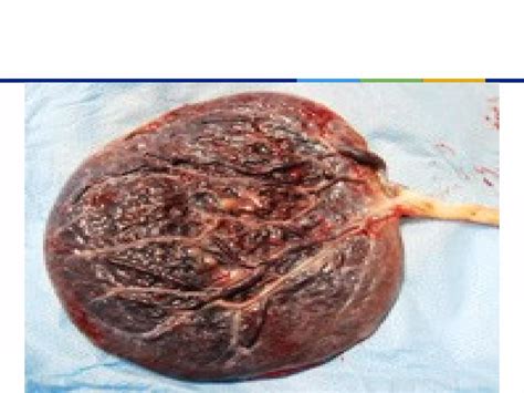 Abnormalities Of Placenta And Cordppt Ppt