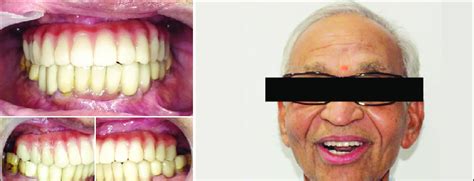 A Final Prosthesis B Postoperative Extraoral B A Download