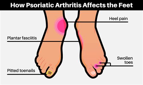 Psoriatic Arthritis In The Feet Symptoms Treatment Home 40 Off
