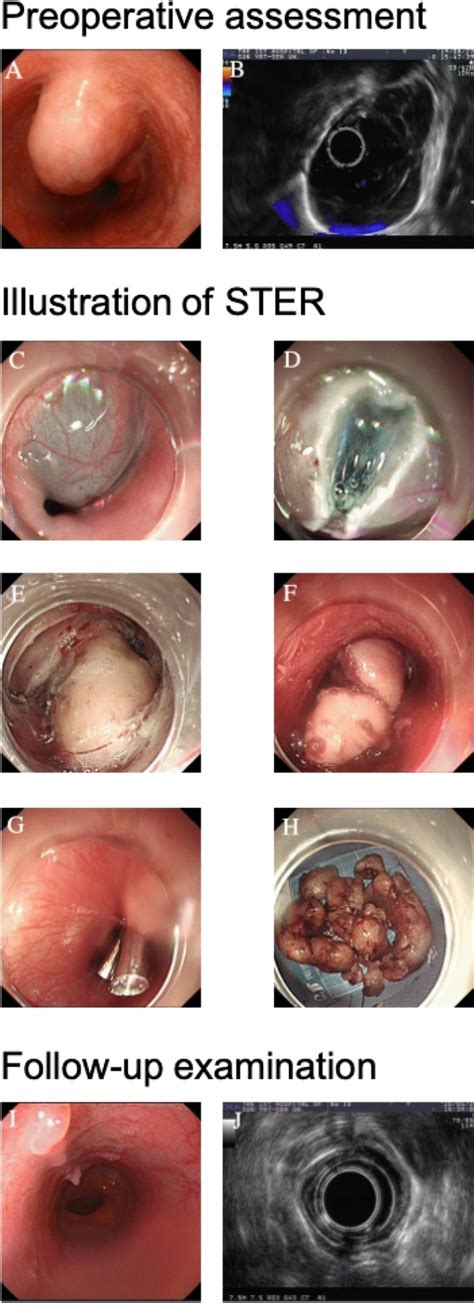 The Efficacy And Safety Of Submucosal Tunneling Endoscopic Resection In