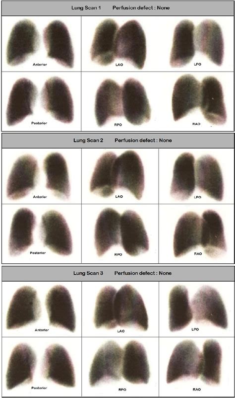 Figure From A Novel Anatomical Lung Phantom And Its Applications In Lung Perfusion Scans For