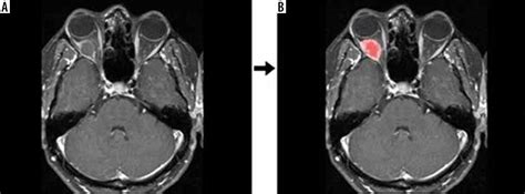 Segmentation Of Orbital And Periorbital Lesions Detected In Orbital
