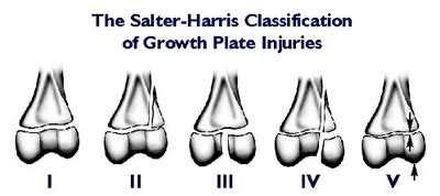 Paediatric Hand Fractures Bondi Junction Hand Therapy