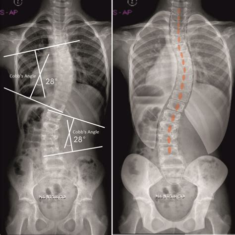 What Is Scoliosis Types Treatments And Chiropractic Benefits