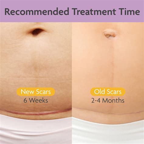2 C Section Scars Is My C Section Scar Healing Well One On One